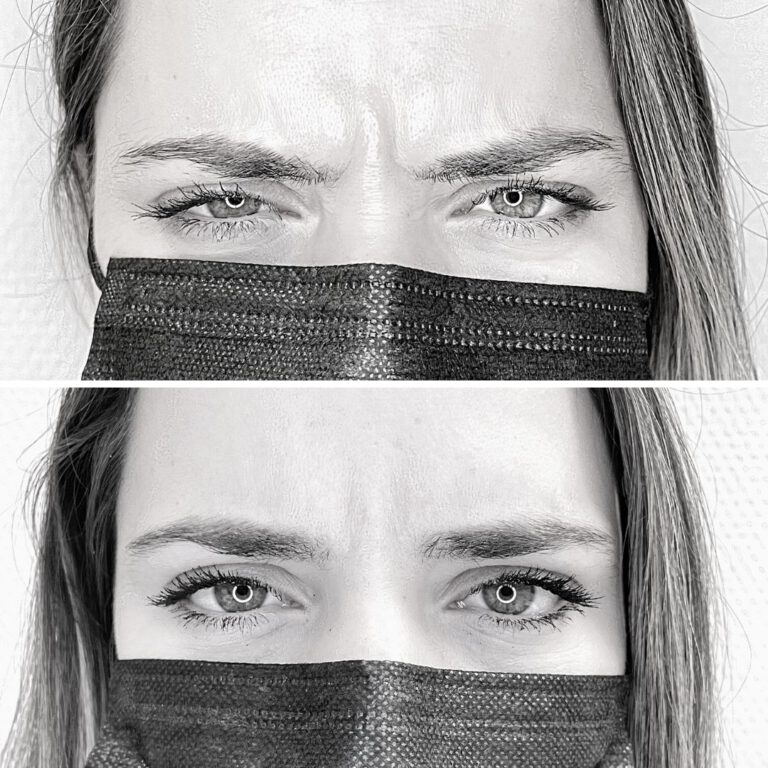 Baby Botox een subtiele botox behandeling