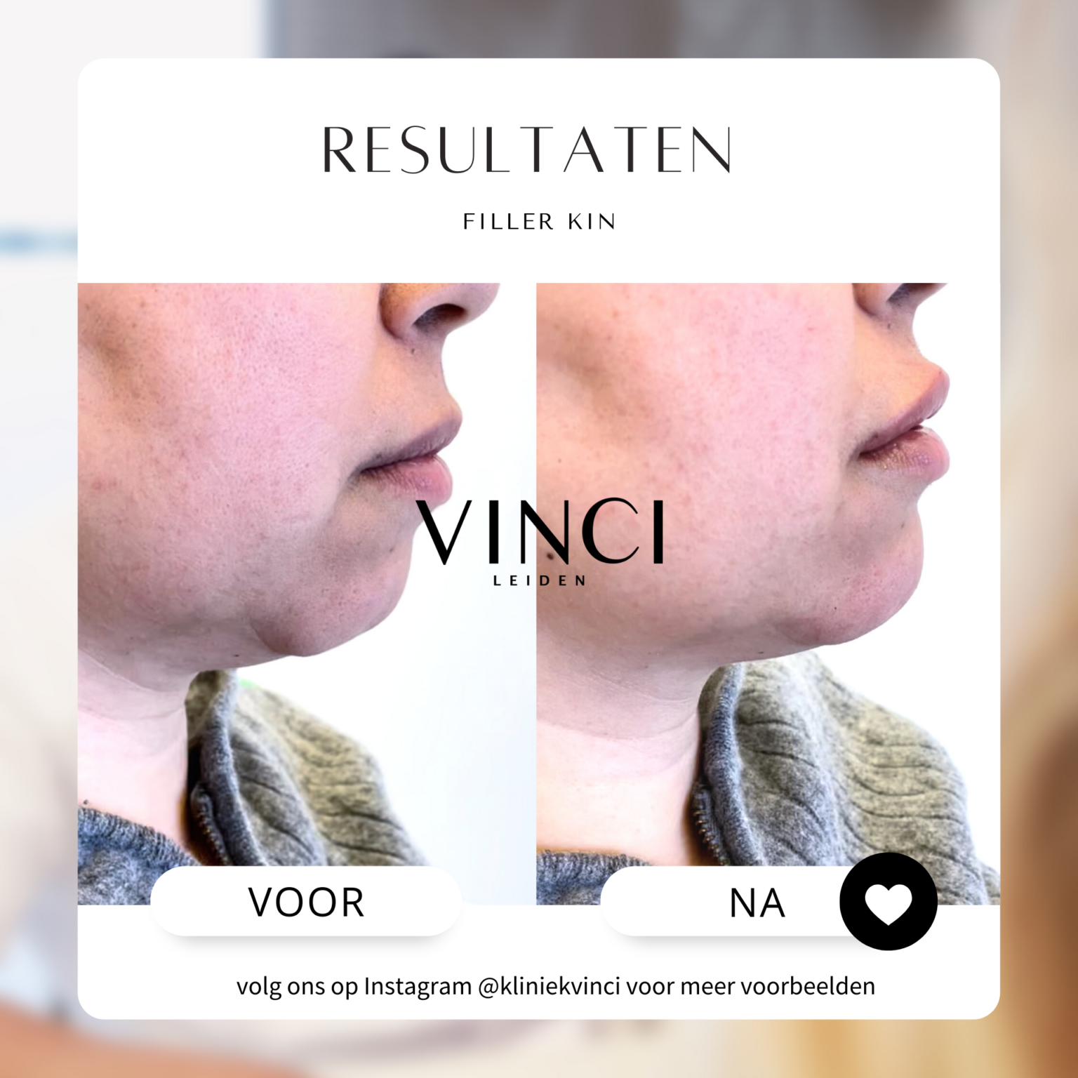 kin filler - Kliniek Vinci
