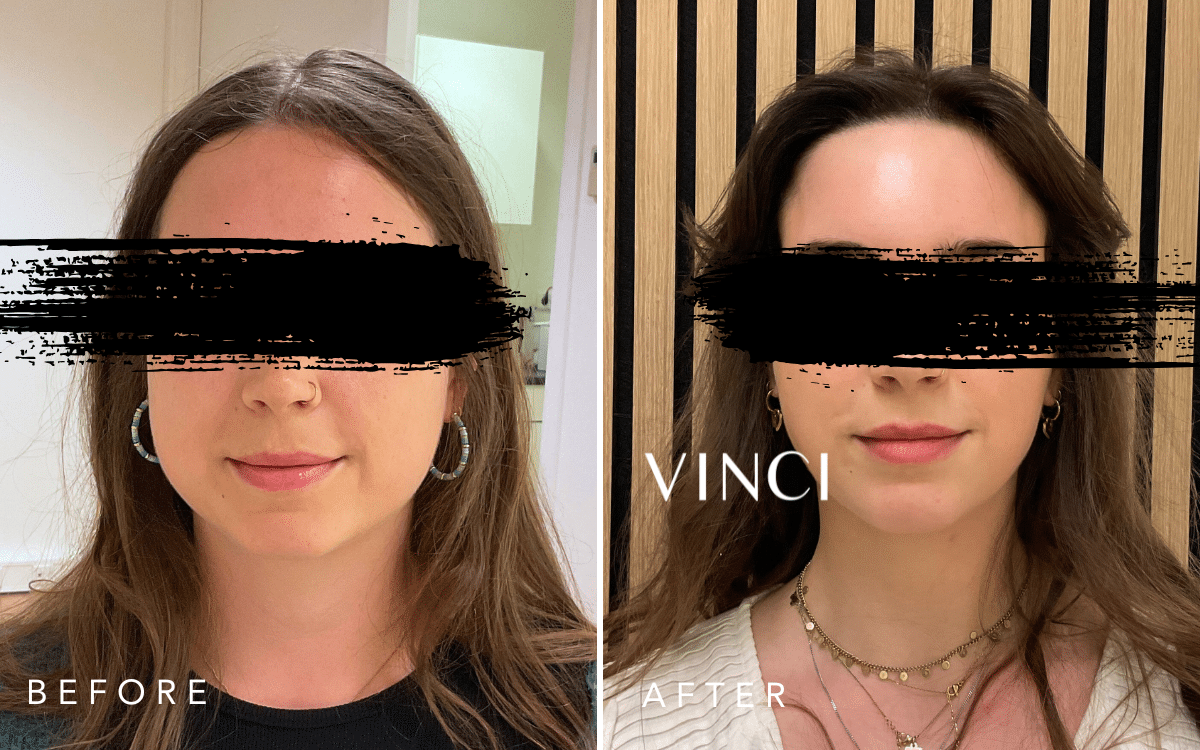 Botox face slimming: slanker gezicht met botox